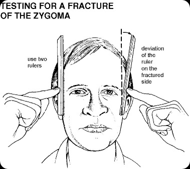 Cirurgia e Traumatologia BucoMaxiloFacial: Maxillofacial injuries